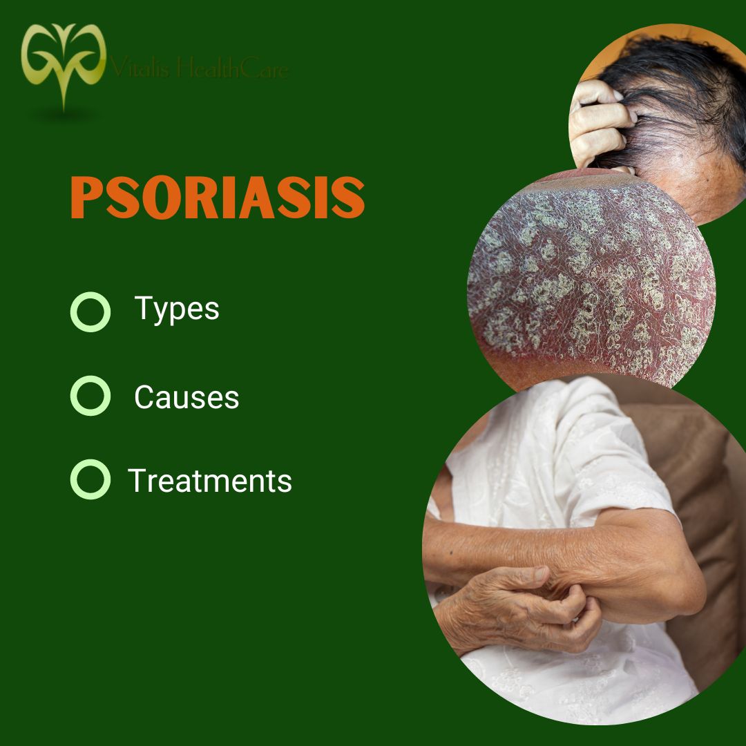 TAKING ACTION ON PSORIASIS – Vitalis Home HealthCare Services
